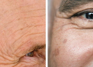 About Actinic Keratosis | LEVULAN® KERASTICK® (aminolevulinic acid HCl ...