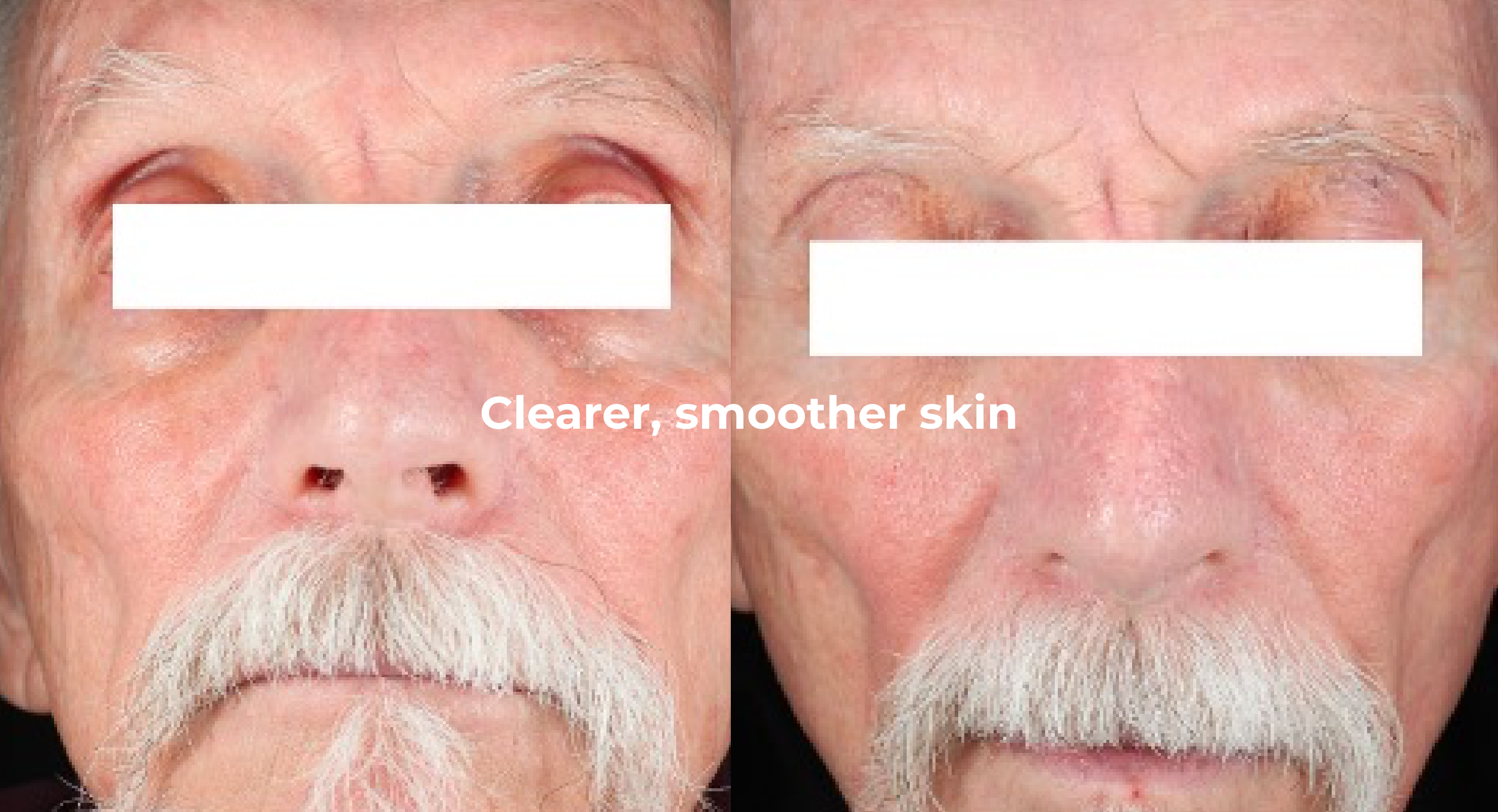 Why LEVULAN and benefits BLU-U | LEVULAN® KERASTICK® (aminolevulinic ...